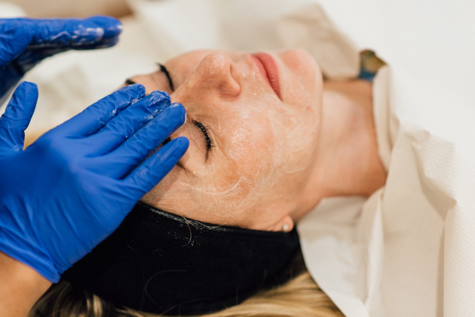 Chemical Peel: Types of Peel, Skin Peel, Medium or Deep